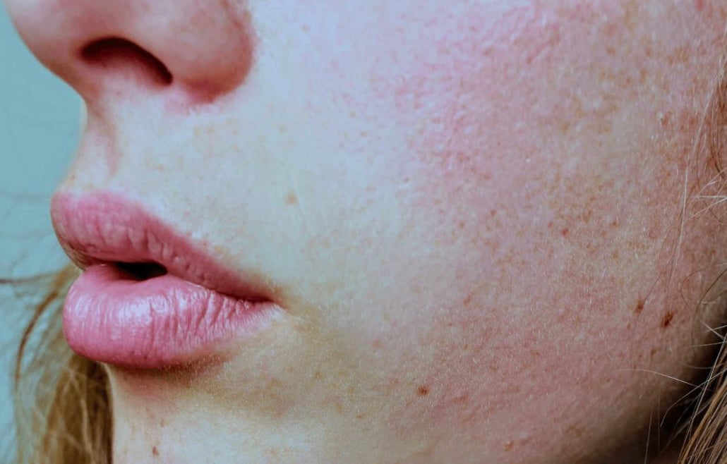 How to Relieve Redness from Face: A Complete Guide – Finn + Emma